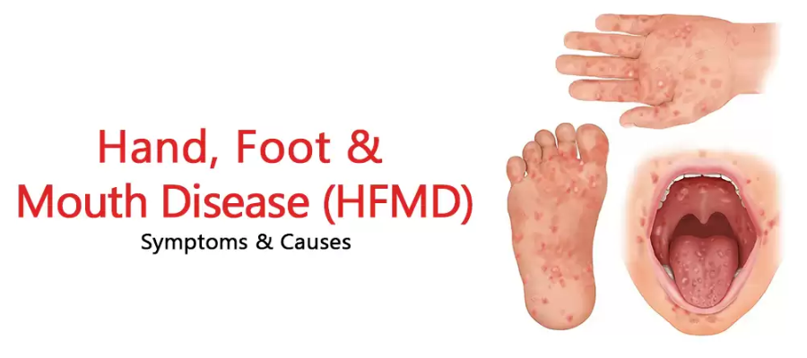 What Are The Common Symptoms And Preventive Measures For Hand Foot And Mouth Disease Hfmd